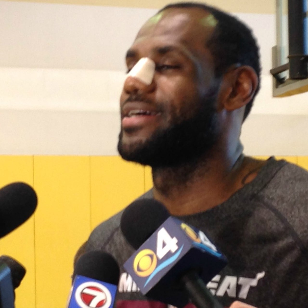 Lebron James Broken Nose