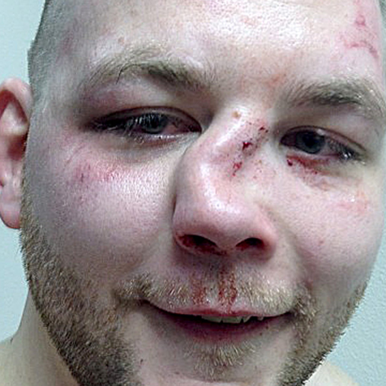 broken nose aftermath